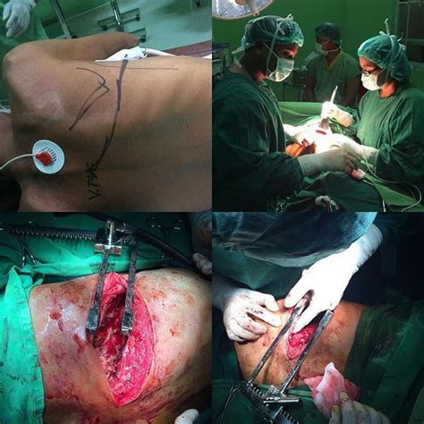 Thoracotomy Medizzy