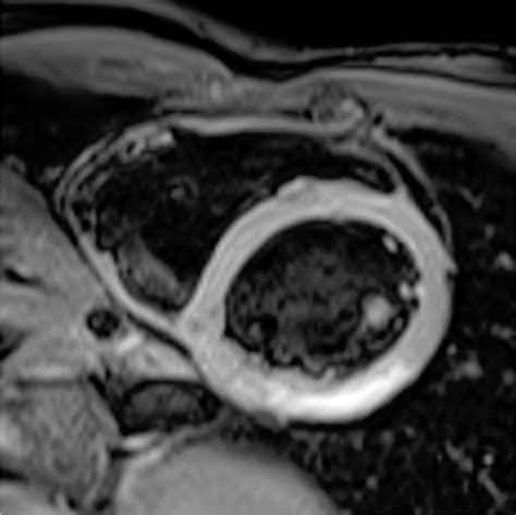 ¿qué Es La Resonancia Magnética Hc Marbella Hc Marbella