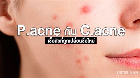 สิว Pacnes เปลี่ยนเป็น Cacnes Sister Nan The Science Behind Beauty
