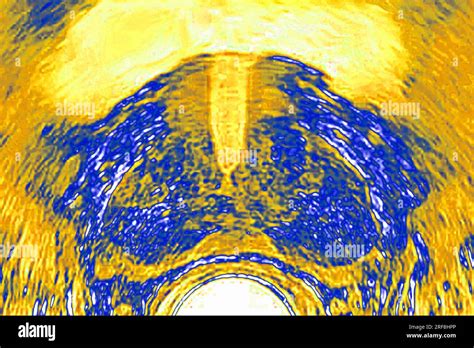Prostate Healthy Prostate Gland Visualized In Ultrasound In Frontal