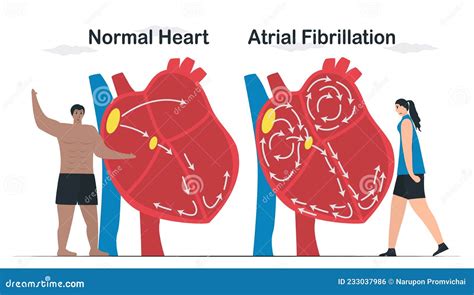 Afib Cartoons Illustrations Vector Stock Images 9 Pictures To Download From CartoonDealer Com