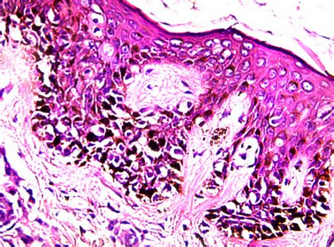 Pathology Outlines Dysplastic Nevus