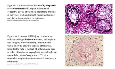 Hyperplastic Arteriosclerosis