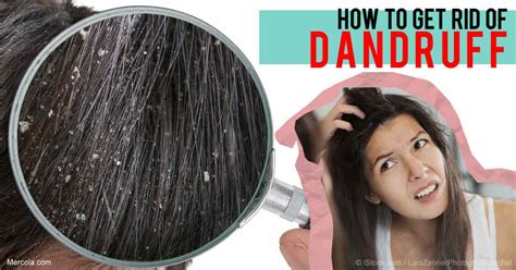 How To Get Rid Of Dandruff Naturally