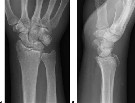 Radial Styloid Fractures Journal Of Hand Surgery