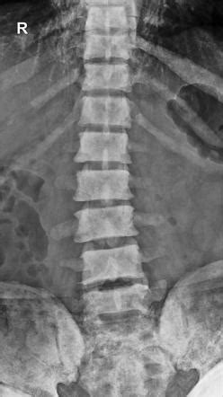 Diffuse Bone Sclerosis Radiology Case Radiopaedia Org