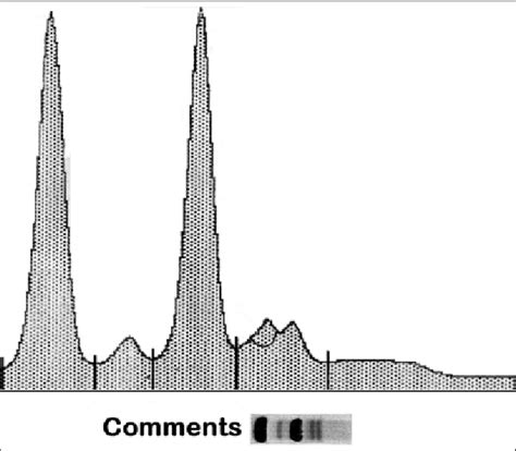 M Spike On Alpha 2 Region Is Seen On The Protein Electrophoresis In