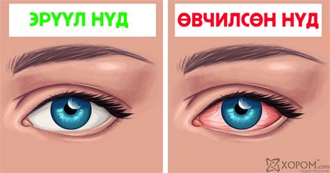 Нүд хуурайших асуудал сүүлийн үед түгээмэл тохиолдох өвчний нэг болоод