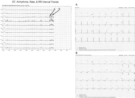 A Research Method For Detecting Transient Myocardial Ischemia In Patients With Suspected Acute
