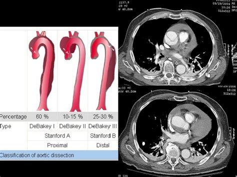 University Of Toledo Radiology Type A Aortic Disection With Pericardial Hematoma