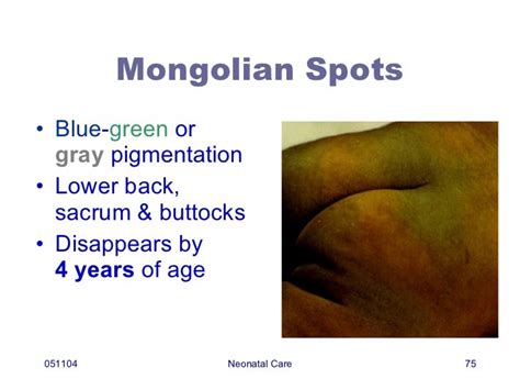 Blue Mongolian Spots What Is The Mongolian Blue Spot Ajya