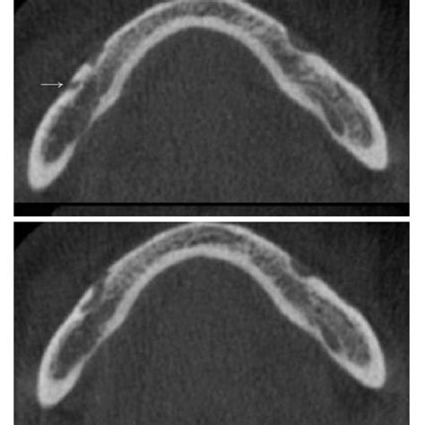 Pdf Accessory Mental Foramen A Rare Anatomical Variation Detected By Cone Beam Computed