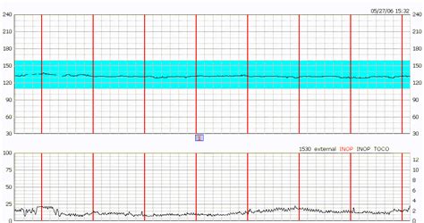 Fetal Tracing Index Electronic Fetal Monitoring