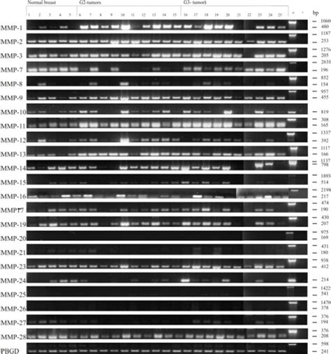 Expression Of Mmp Mrna In Human Normal Breast And Breast Cancer Tissue