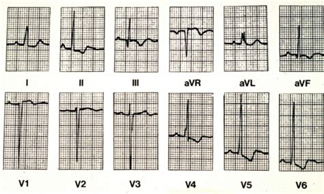 Aortic Insufficiency Flashcards Quizlet