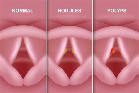 Vocal Cord Lesions Types Etiology Symptoms And Treatment