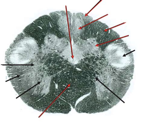 Neuro Quiz 1 Caudal Medulla Diagram Quizlet