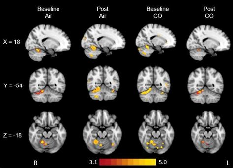 Mean Cerebellar Activation For All Scans Whole Brain Analysis Maps