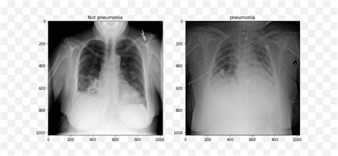 Deep Learning For Detecting Pneumonia From X Ray Images Pneumonia Vs