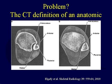 Ankle Fracture Update Ota Resident Core Curriculum Lecture