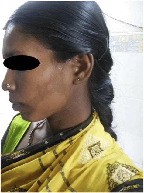 Borderline Tuberculoid Leprosy With Patch Over Face Download