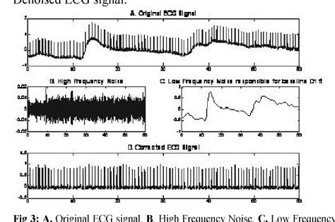Figure 3 From Ecg Feature Extraction And Classification Of Anteroseptal