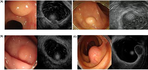 Figure 2 From Clinicopathologic And Endosonographic Characteristics Of