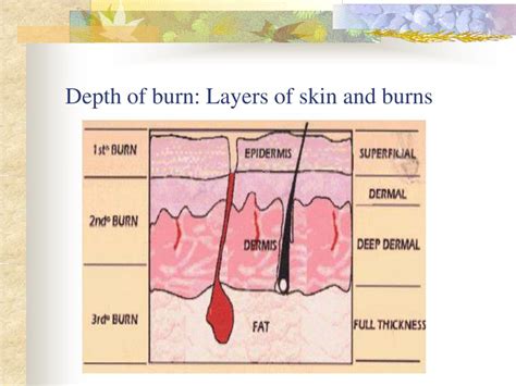 Ppt Integumentary Burns Powerpoint Presentation Free Download Id 337965