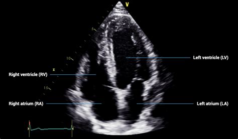 Echo Basics Apical And Subcostal Views • Litfl • Radiology Library