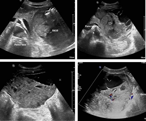 Stomach Gist Radiology Cases