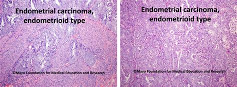 Endometrial Carcinoma