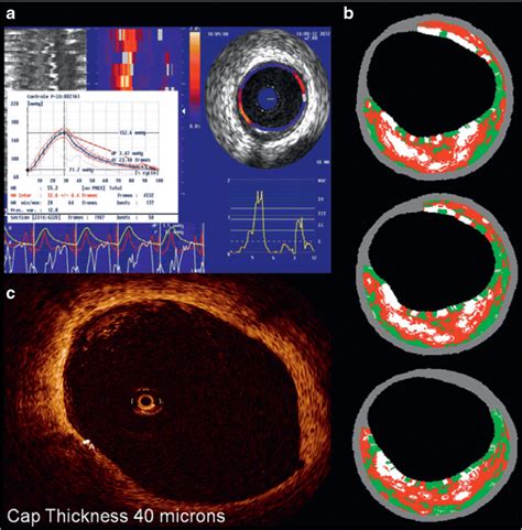 A In The Upper Left Palpogram Showing Stain Value Of 14 Rotterdam