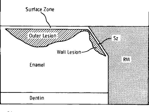 Figure 1 From Prevention Of In Vitro Secondary Caries With An