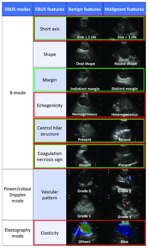 Representative Endobronchial Ultrasound Ebus Features Suggestive Of