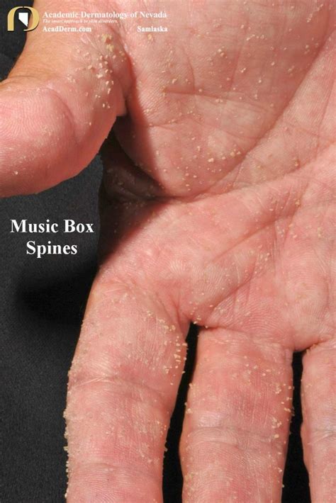 Music Box Spine Keratoses Punctate Keratoses Of The Palms And Soles