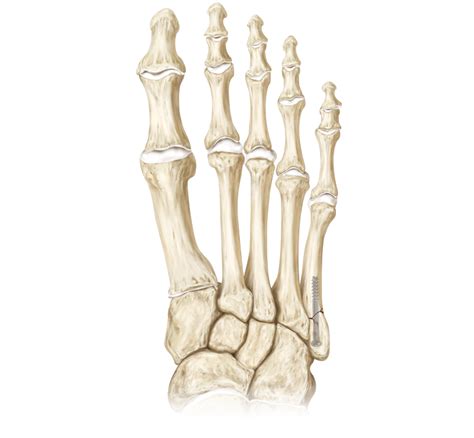 Arthrex Forefoot Fractures