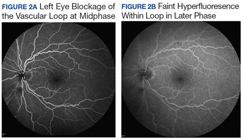 Venous Loop Retina