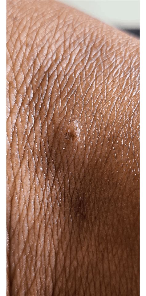 Got Bit By A Bug Bite Its An Unusual Bite And Im Freaking Out R