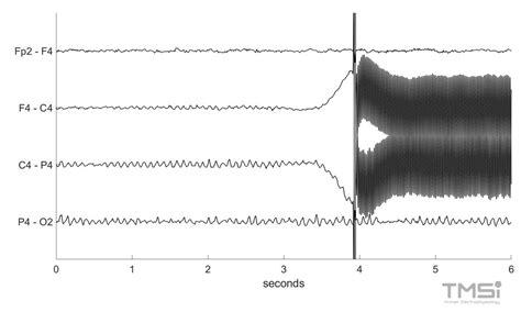 Tmsi — An Artinis Company — Common Non Physiological External Eeg Artifacts