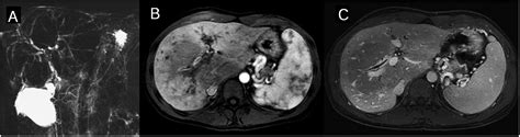 Colangitis Crónicas Diagnóstico Diferencial Y Papel De La Resonancia