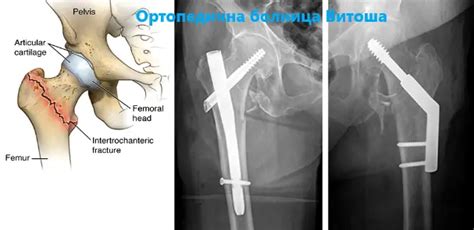Фрактура на бедрена кост Счупване на шийката на бедрената