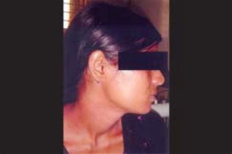 Redness On The Side Of The Neck After The Use Of Chlorhexidine Formulation Download Scientific