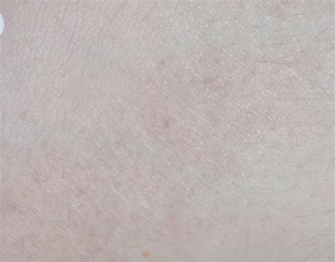 Skin Results Atopic Dermatitis Opzelura® Ruxolitinib