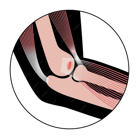 Premium Vector Lateral Epicondylitis Tennis Elbow