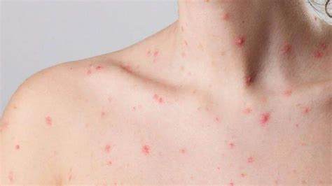 Recomendaciones Para Prevenir La Viruela Del Mono Diario Del Yaqui