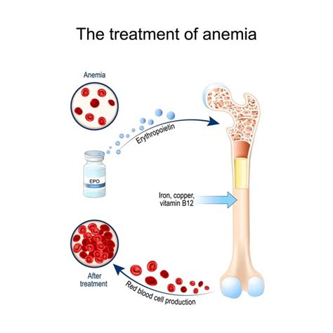 9 Anemia Before After Stock Vectors And Vector Art Shutterstock
