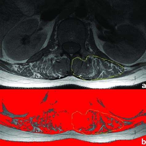 Fat Fraction Of The Paraspinal Muscles During Follow Up Images