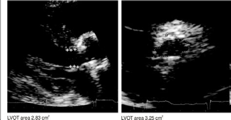 Figure 1 From Comparison Between Patient Aortic Valve Prosthesis Mismatch Determined By