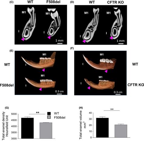Abnormal Tooth Enamel Phenotype Of F508del And Cystic Fibrosis Download Scientific Diagram