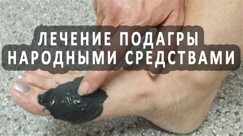 Лечение подагры народными средствами - YouTube